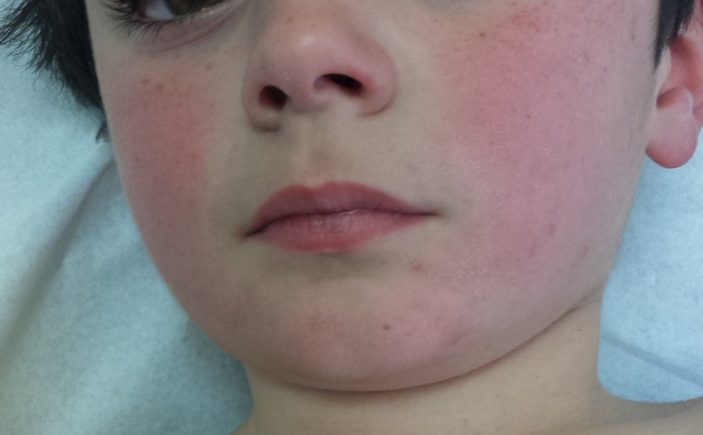 Eritema Infeccioso o Quinta Enfermedad | infociudad